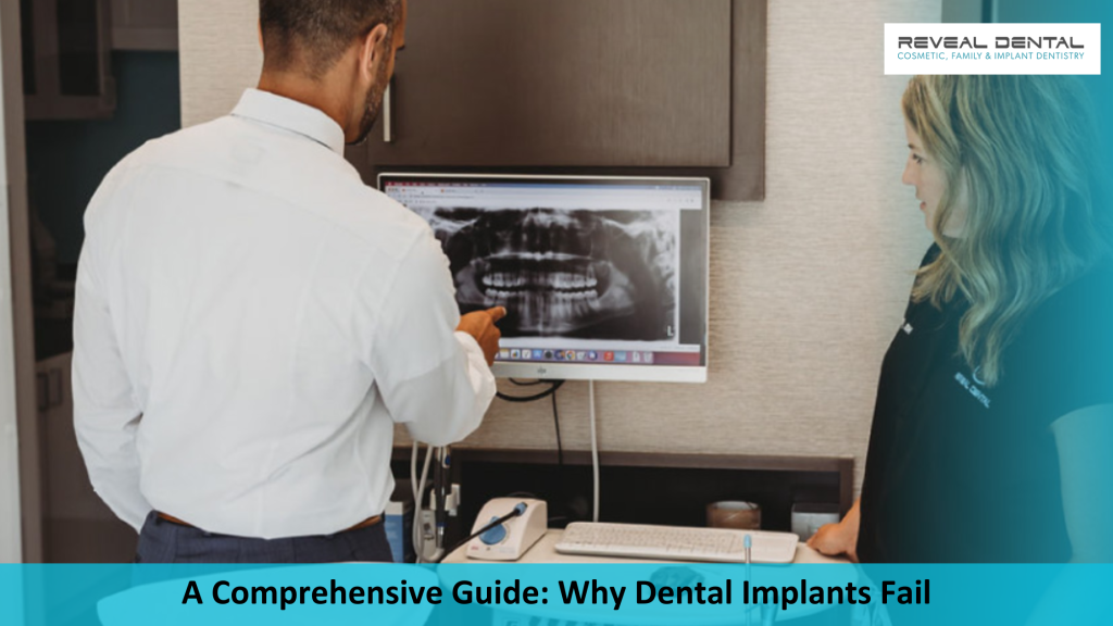 8 Reasons Dental Implants Fail in Cedar Park- Reveal Dental